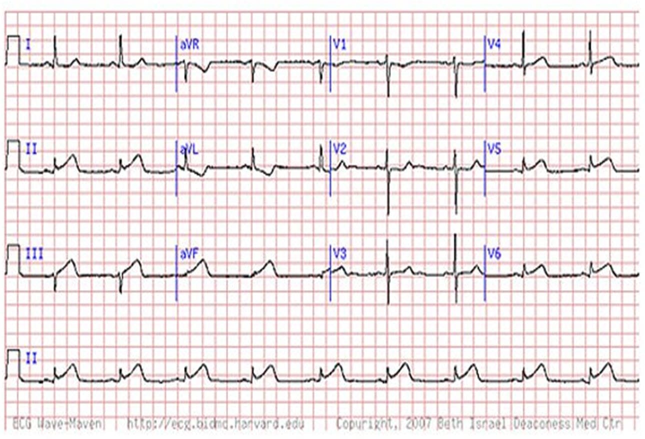 Are You Missing Subtle MI Clues on ECGs? Test Your Skills