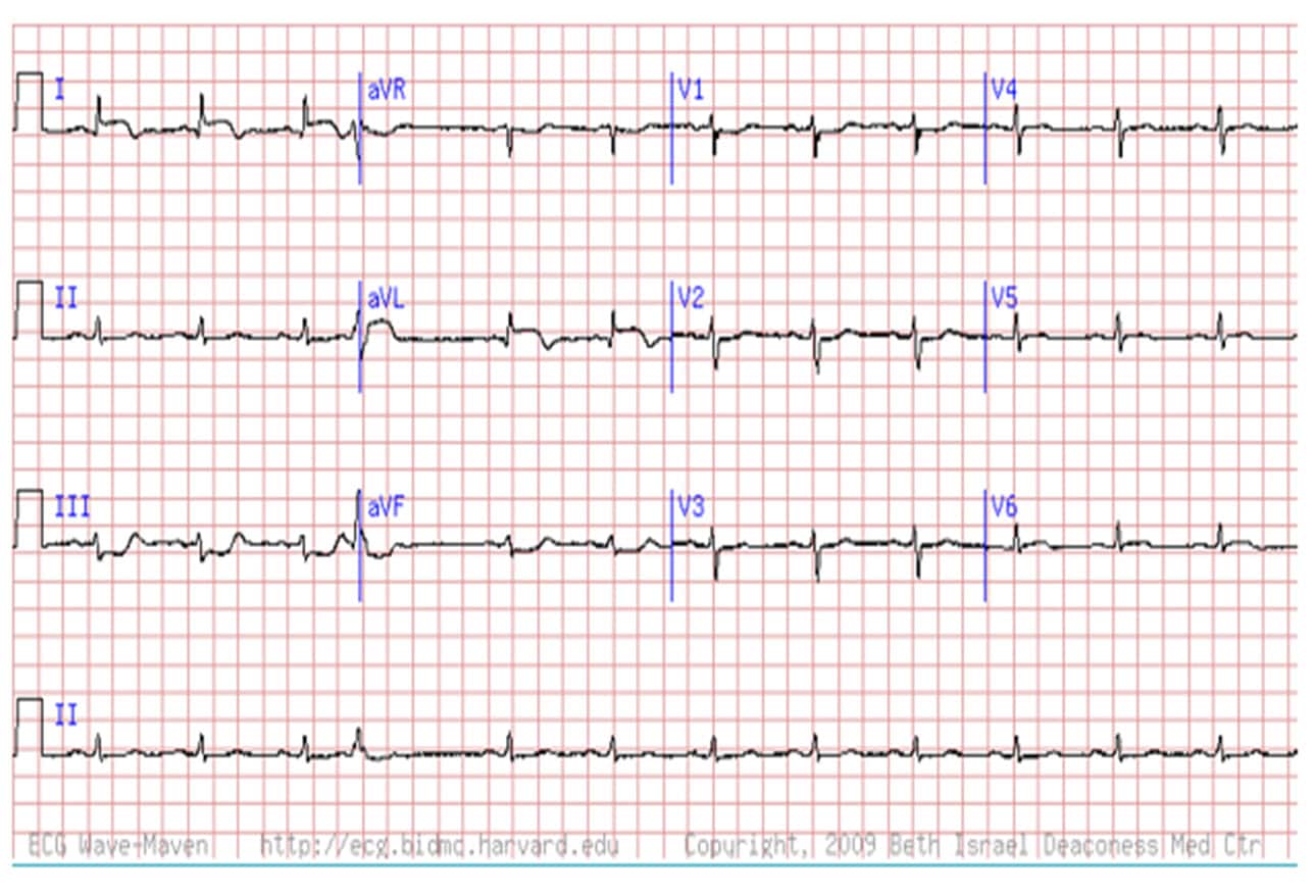 Are You Missing Subtle MI Clues on ECGs? Test Your Skills