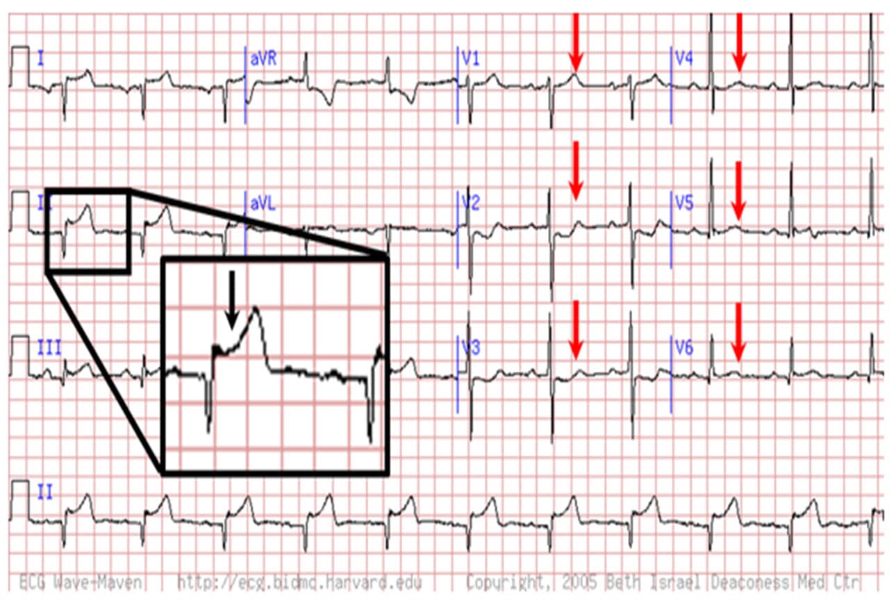 Are You Missing Subtle MI Clues on ECGs? Test Your Skills