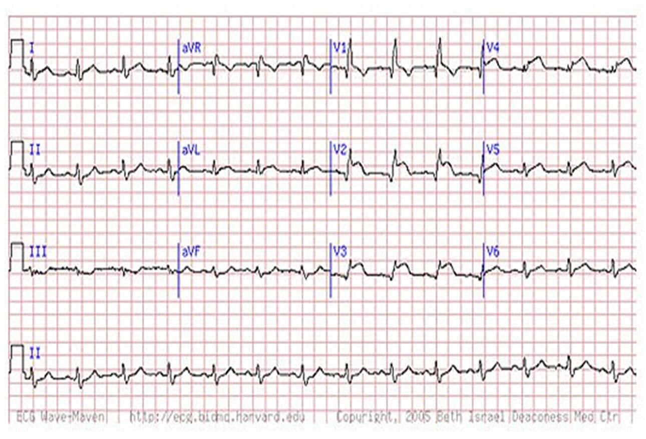 Are You Missing Subtle MI Clues on ECGs? Test Your Skills