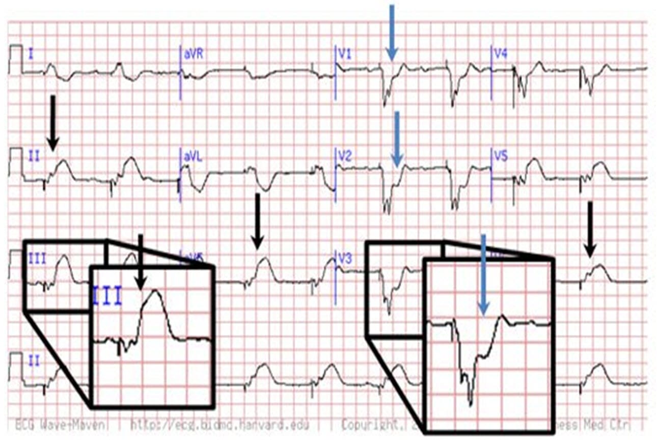 Are You Missing Subtle MI Clues on ECGs? Test Your Skills