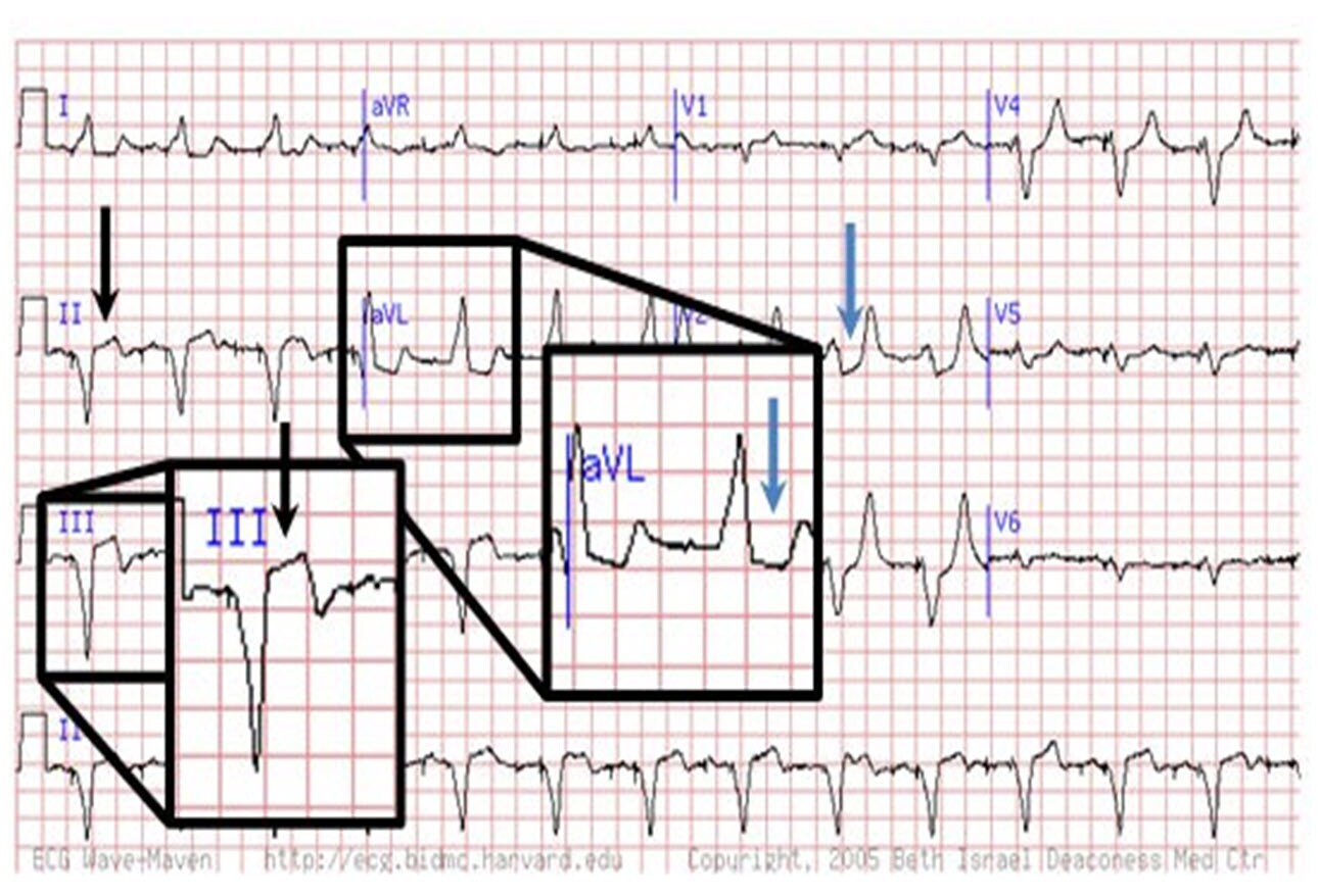 Are You Missing Subtle MI Clues on ECGs? Test Your Skills