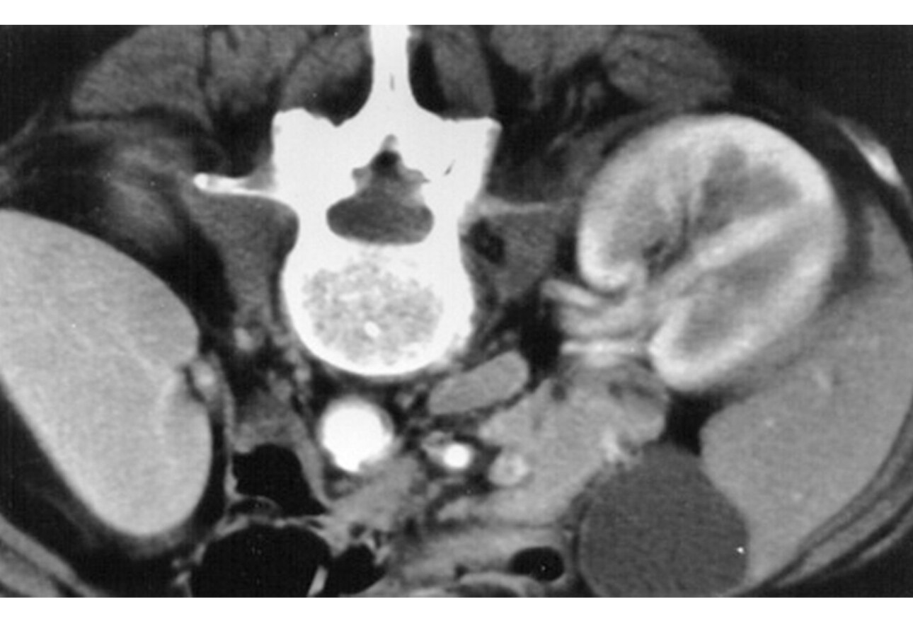 Multidrug Resistant Organisms (MDROs): Growing, Spreading, and Killing
