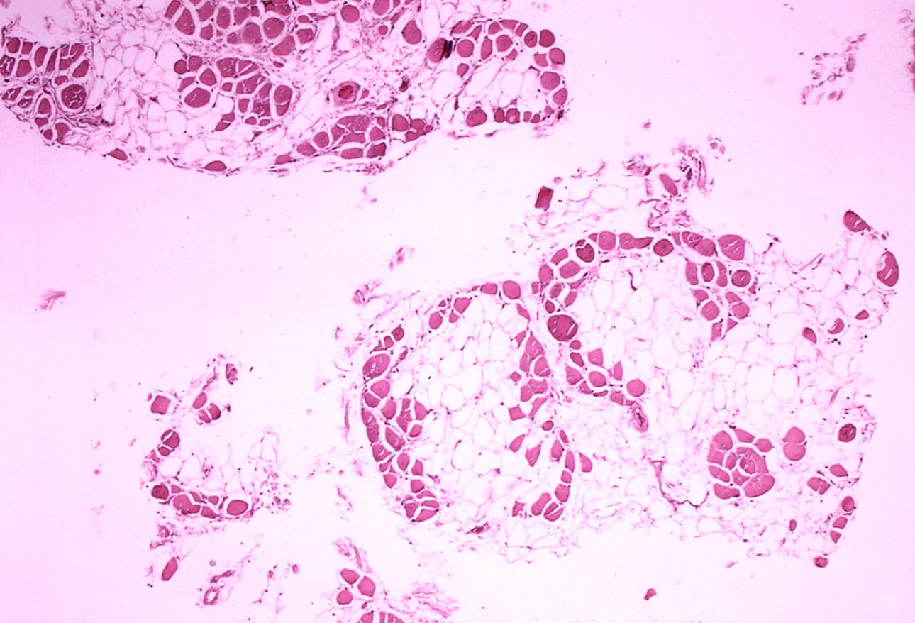 Myopathies: Muscling Your Way to the Diagnosis