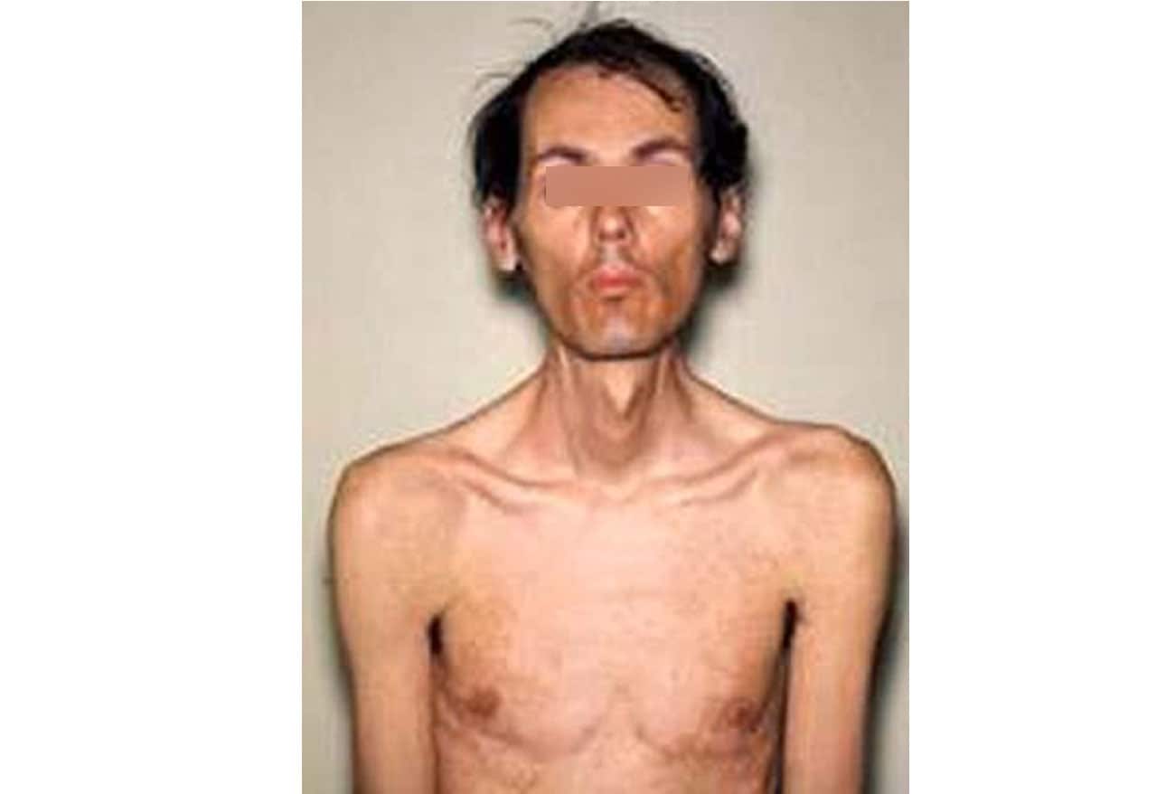 Myopathies: Muscling Your Way to the Diagnosis