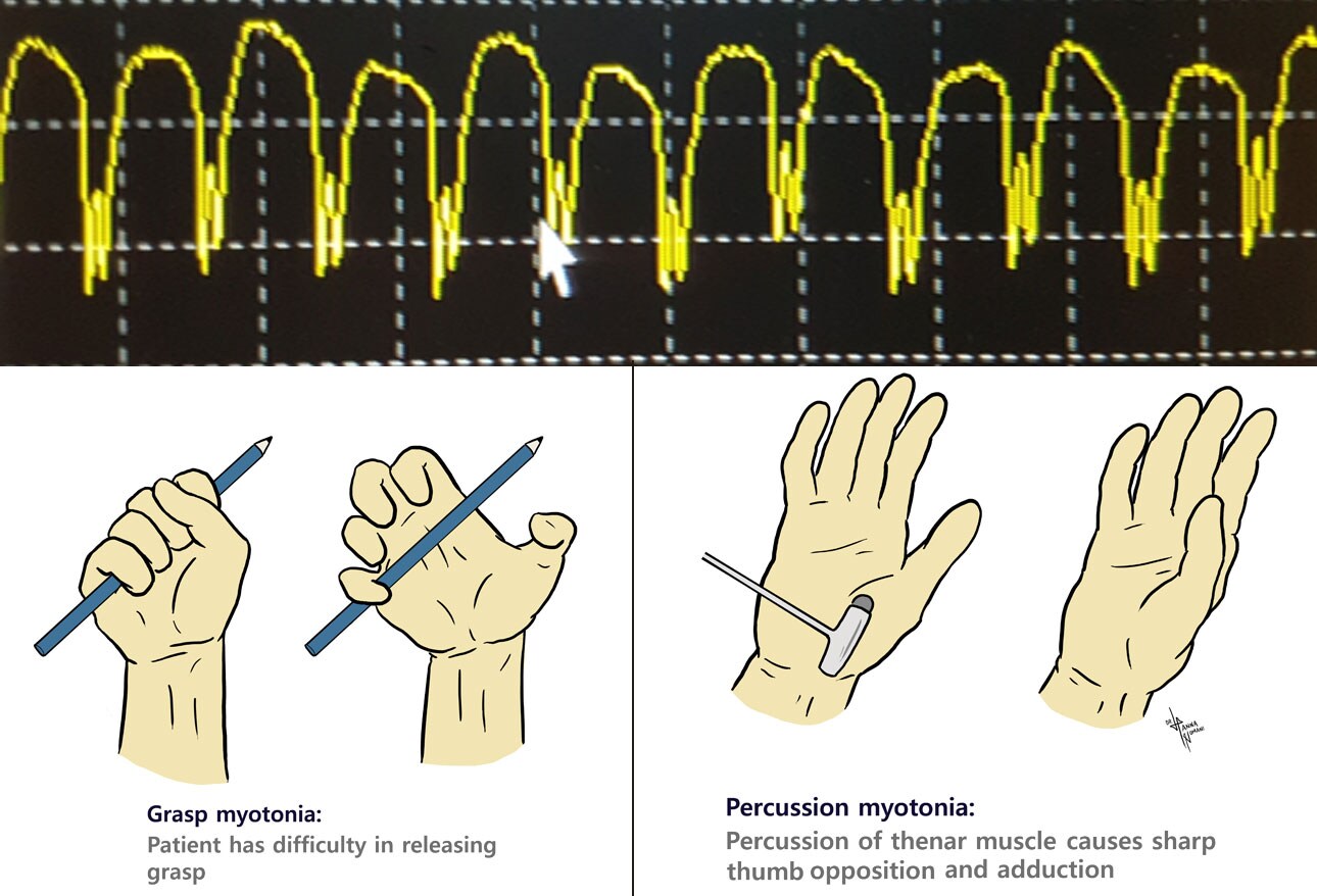 Myopathies: Muscling Your Way to the Diagnosis