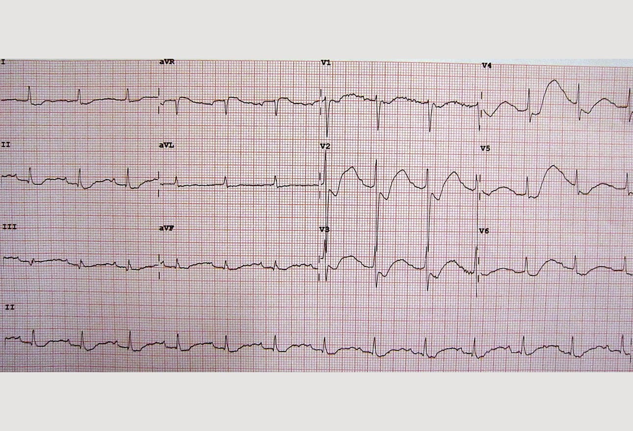 Myopathies: Muscling Your Way to the Diagnosis