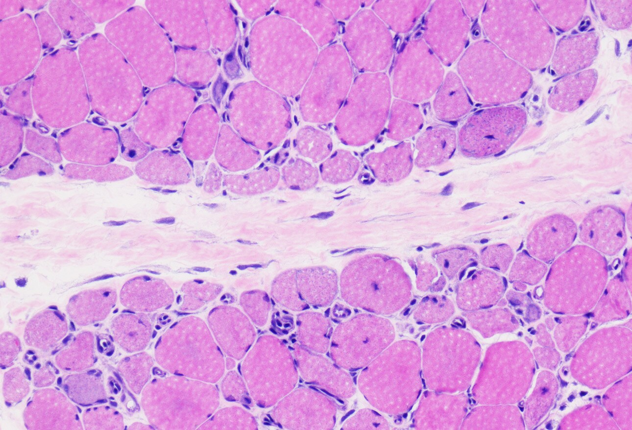 Myopathies: Muscling Your Way to the Diagnosis