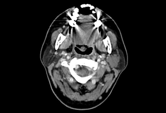 10 Patients With Neck Masses: Identifying Malignant Versus Benign