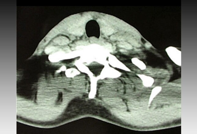 10 Patients With Neck Masses: Identifying Malignant Versus Benign