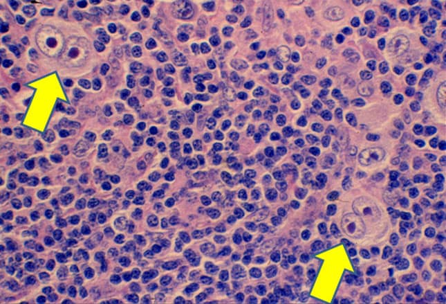 10 Patients With Neck Masses: Identifying Malignant Versus Benign