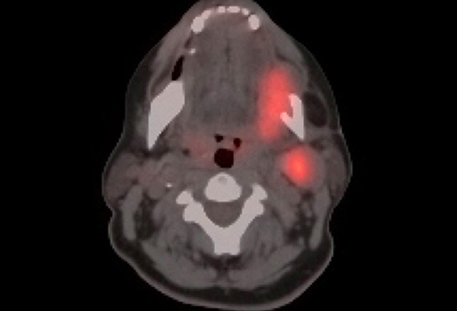 10 Patients With Neck Masses: Identifying Malignant Versus Benign