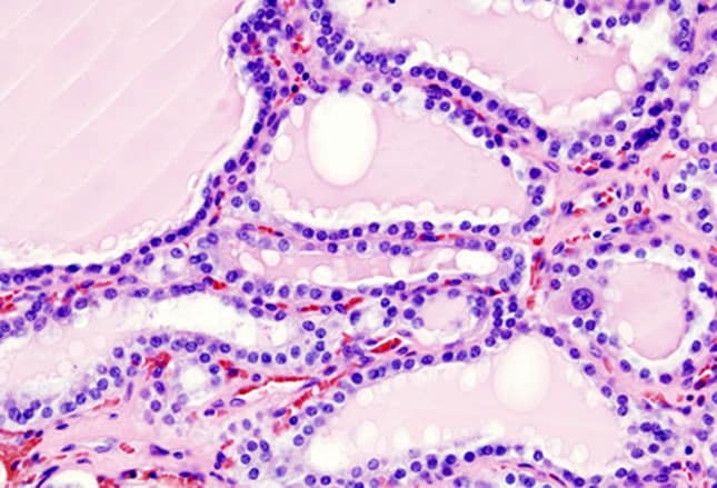 10 Patients With Neck Masses: Identifying Malignant Versus Benign