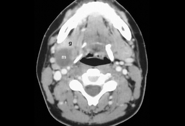 10 Patients With Neck Masses: Identifying Malignant Versus Benign
