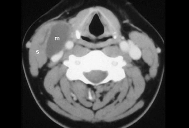 10 Patients With Neck Masses: Identifying Malignant Versus Benign