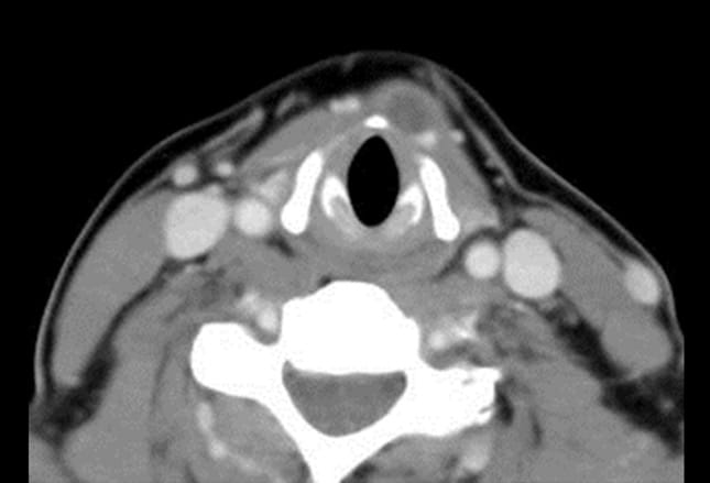 10 Patients With Neck Masses: Identifying Malignant Versus Benign