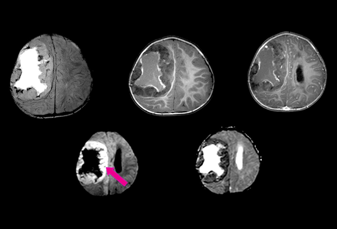 Neonatal and Infant Brain Imaging Evaluation