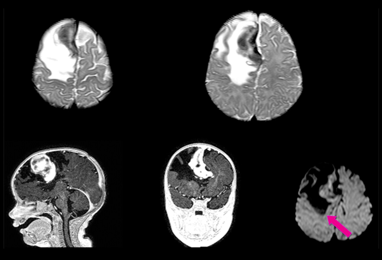 Neonatal and Infant Brain Imaging Evaluation