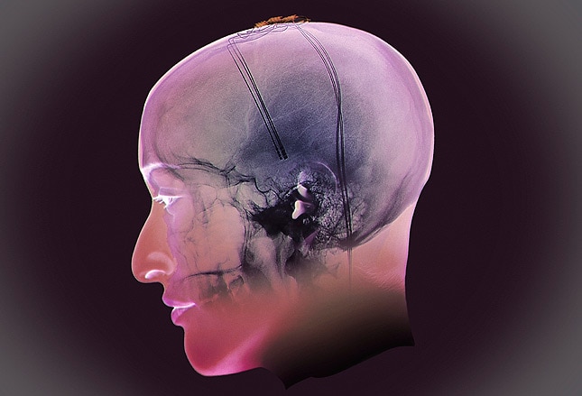 Pain, the Brain, and the Many Uses of Neurostimulation