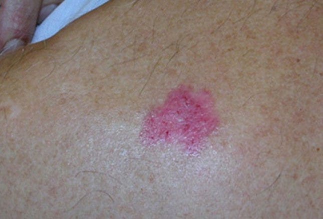 Nonmelanoma Skin Cancers You Need to Know