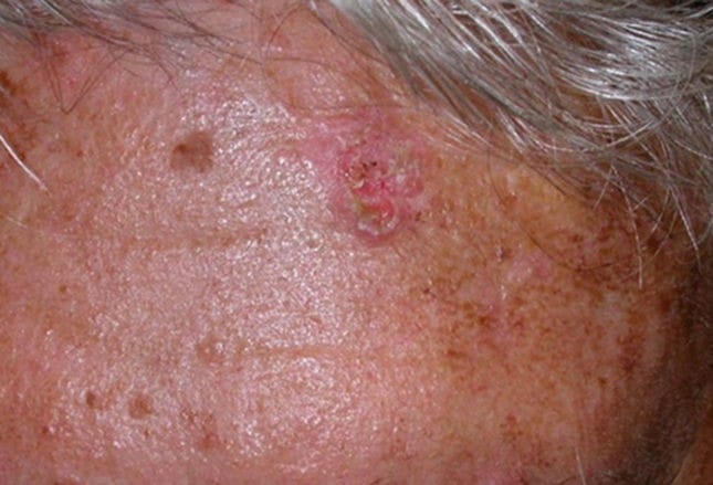 Nonmelanoma Skin Cancers You Need to Know