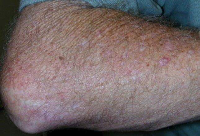 Nonmelanoma Skin Cancers You Need to Know