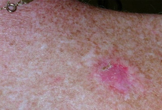 Nonmelanoma Skin Cancers You Need to Know