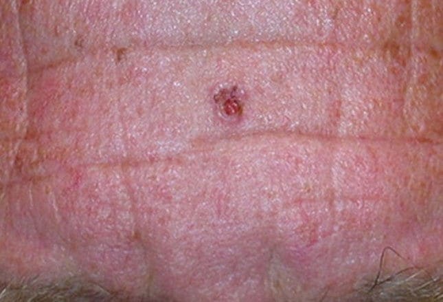 Non Melanoma Skin Cancer