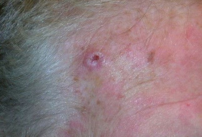 Non Melanoma Skin Cancer