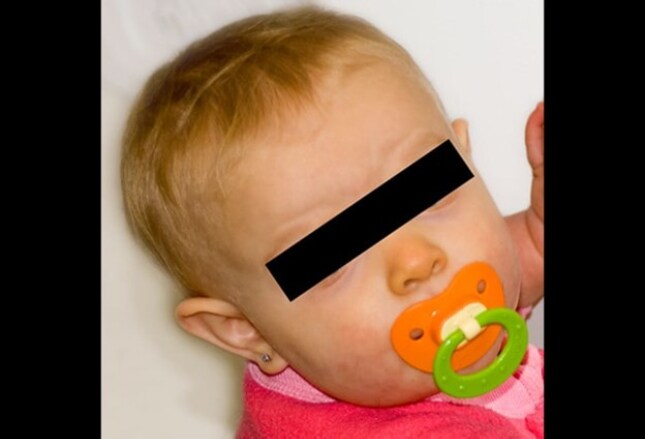 Dermatologic Signs of Nutritional Deficiencies