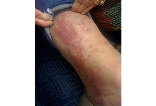 Dermatologic Signs of Nutritional Deficiencies