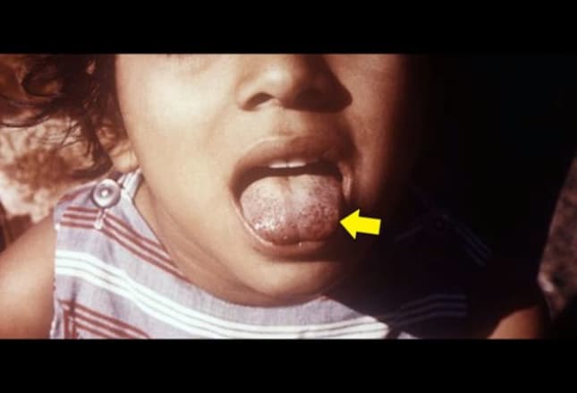 Dermatologic Signs of Nutritional Deficiencies