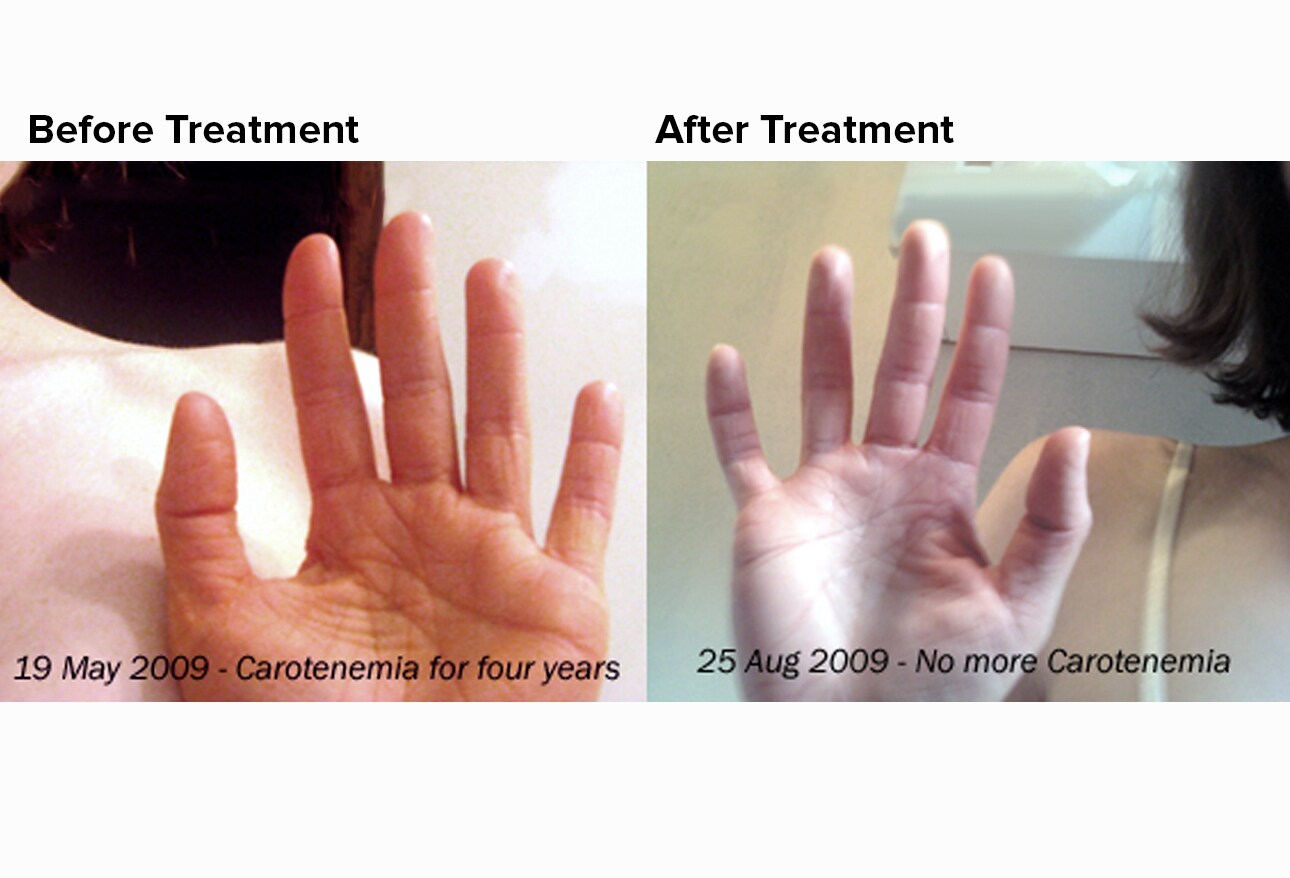 Cutaneous and Mucosal Clues to Nutritional Deficiencies