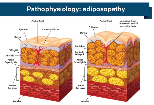Obesity: How to Diagnose and Treat an Epidemic