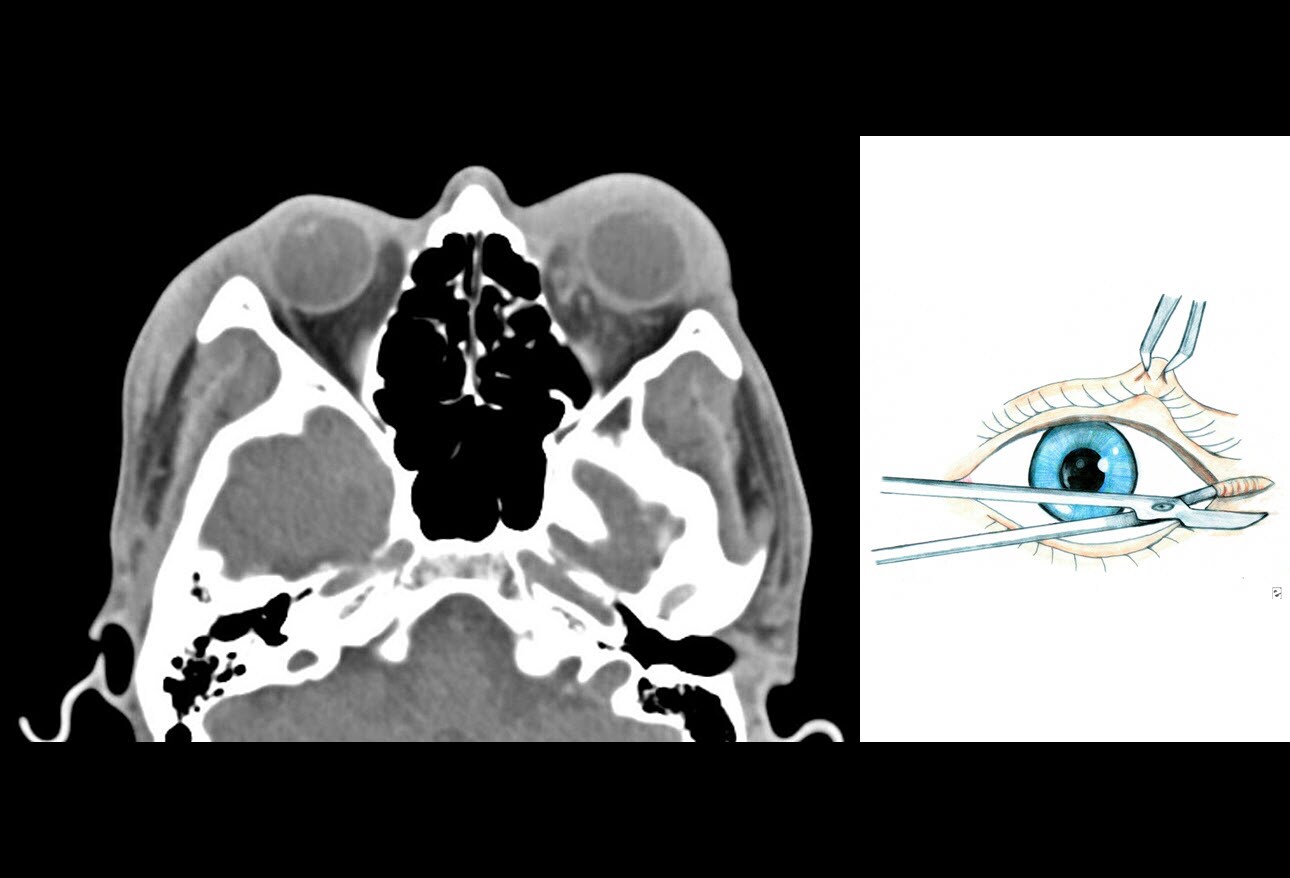 Ocular Trauma: 8 Potentially Devastating Eye Injuries