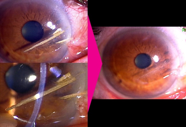 Ocular Trauma: 8 Potentially Devastating Eye Injuries