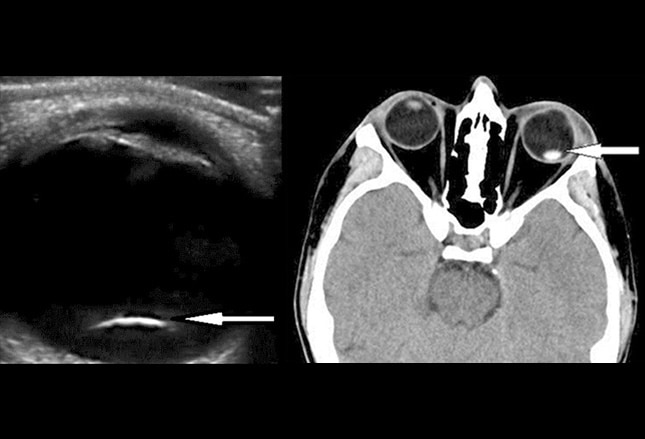 Ocular Trauma: 8 Potentially Devastating Eye Injuries
