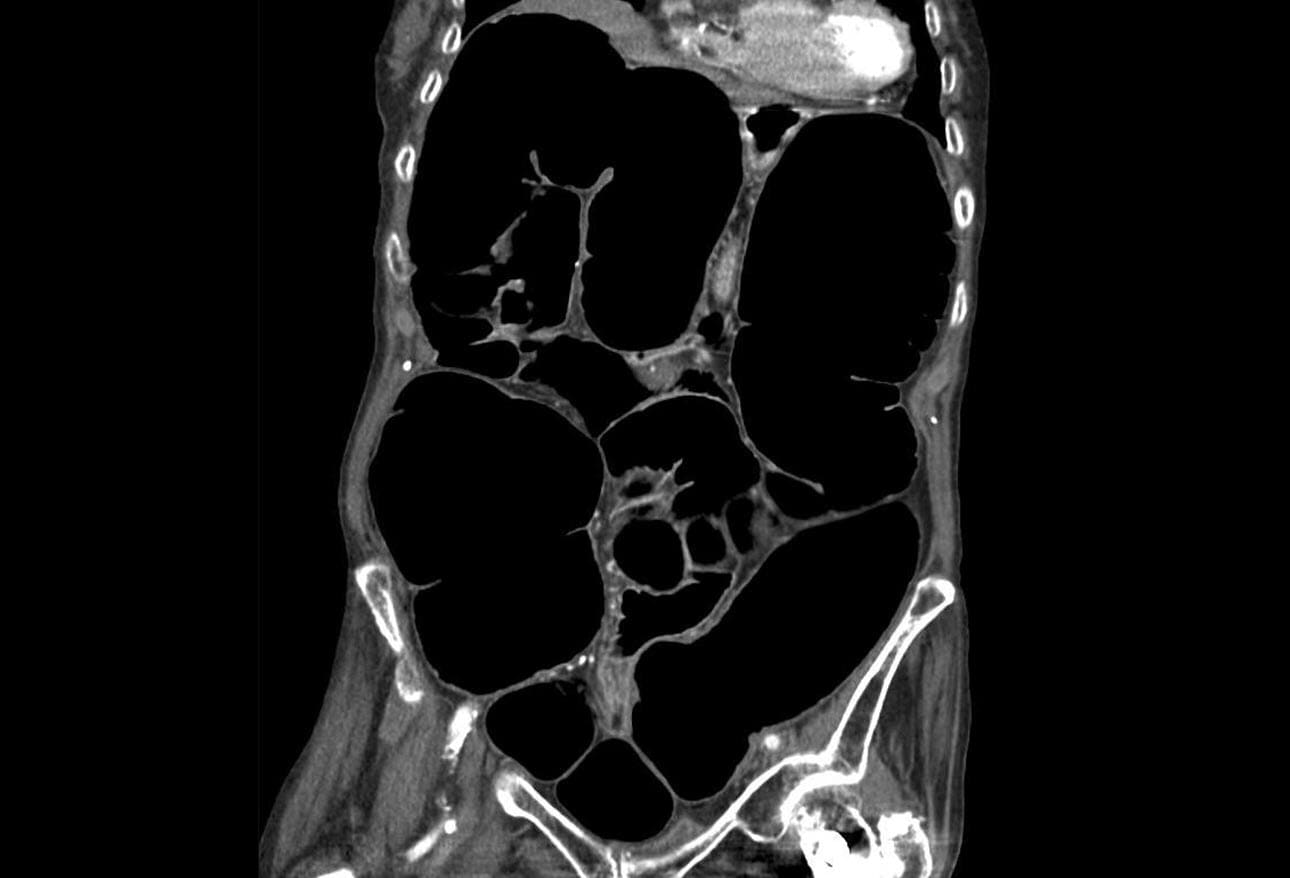 Ogilvie Syndrome (Acute Colonic Pseudo-obstruction): Early Recognition ...