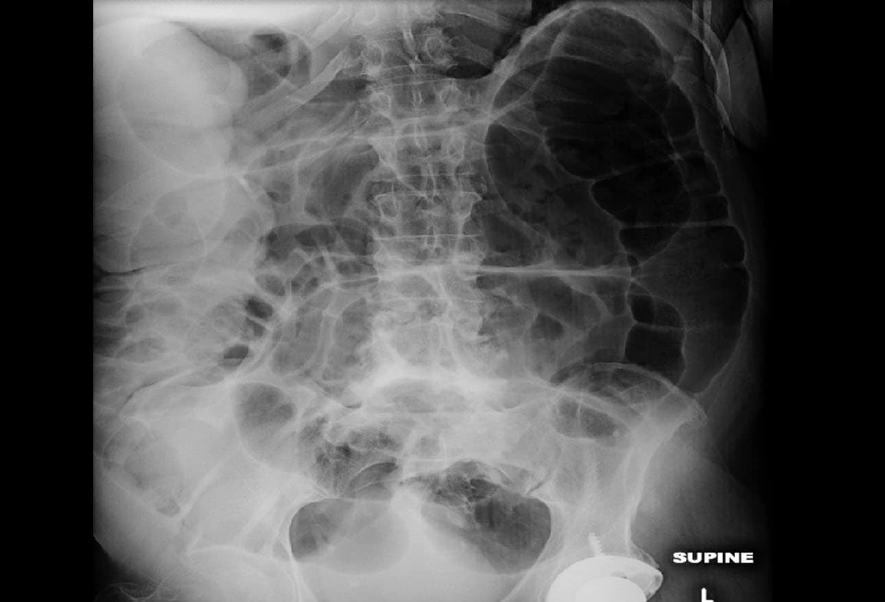 Ogilvie Syndrome (Acute Colonic Pseudo-obstruction): Early Recognition ...