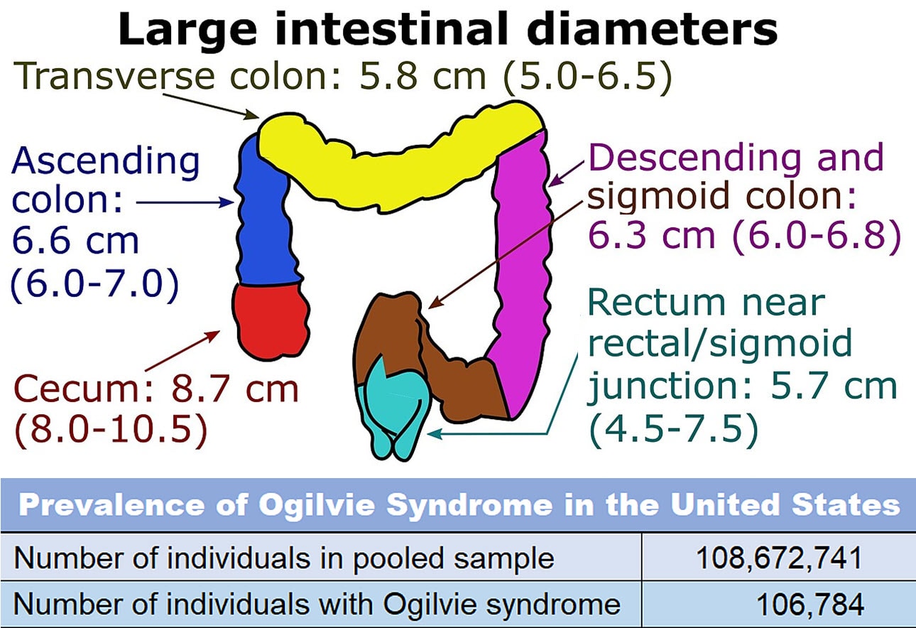 Ogilvie Syndrome (Acute Colonic Pseudo-obstruction): Early Recognition ...