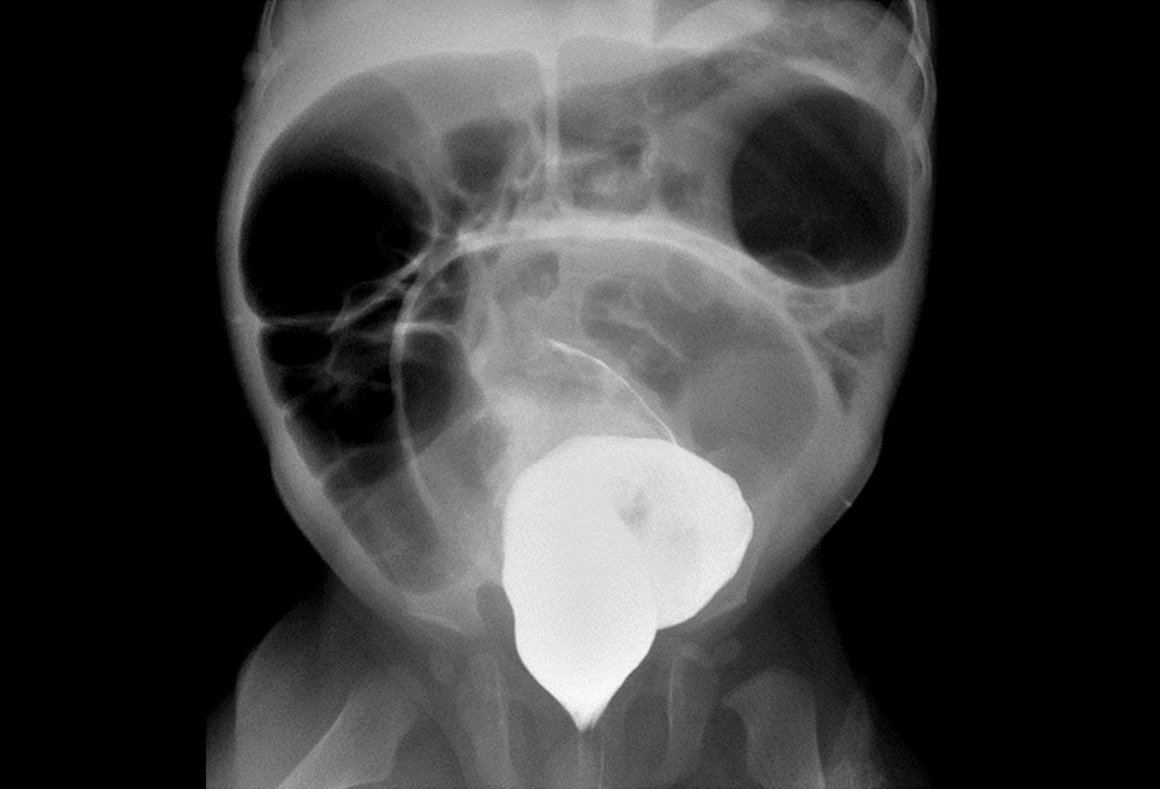 Ogilvie Syndrome (Acute Colonic Pseudo-obstruction): Early Recognition ...