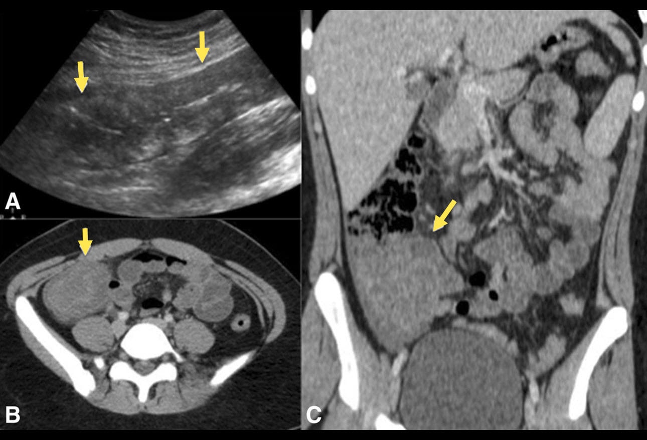 11 Oncologic Emergencies You Need to Know