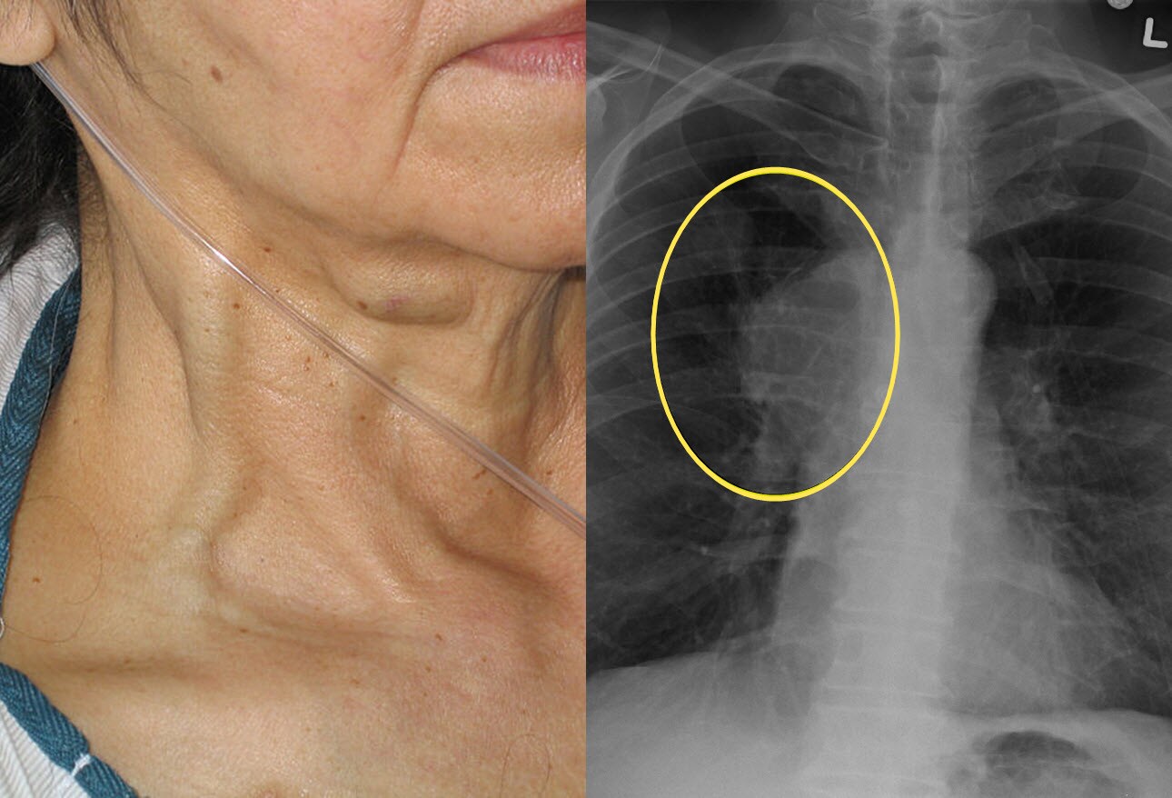 11 Oncologic Emergencies You Need to Know