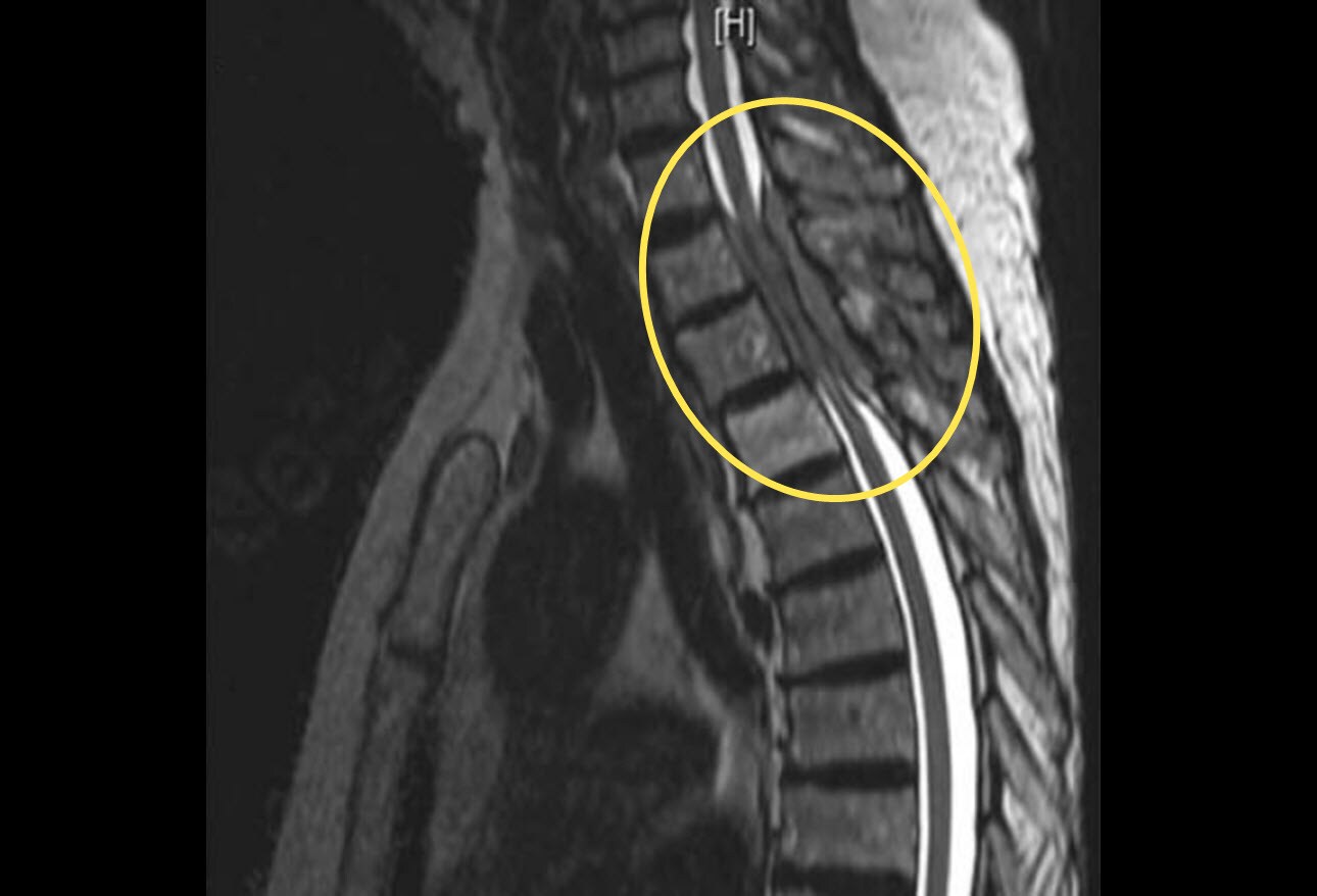11 Oncologic Emergencies You Need to Know