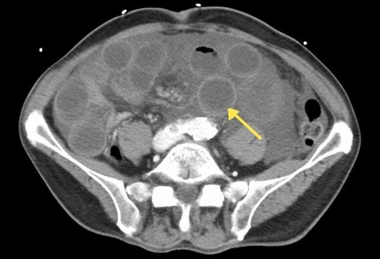 9 Medical Oncologic Emergencies You Need to Know