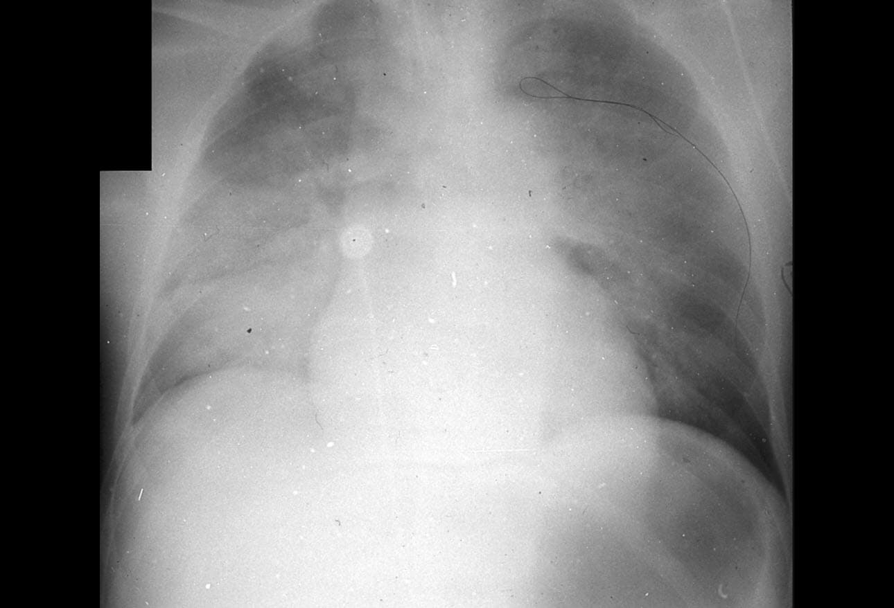 11 Opiate-Related Emergencies: When Highs May Become Fatal