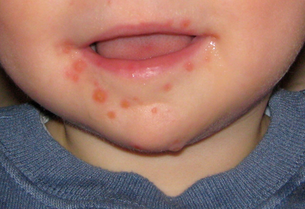 Clues in the Oral Cavity: Are You Missing the Diagnosis?