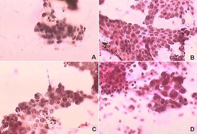Pancreatic Cancer: Difficult Diagnosis, Ominous Outlook