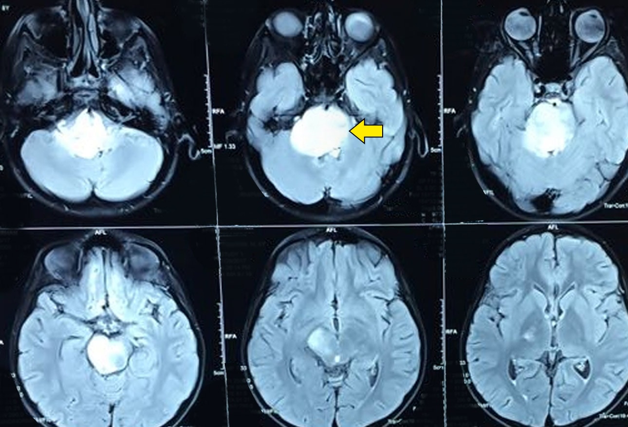Pediatric Brain Tumors Imaging Matters
