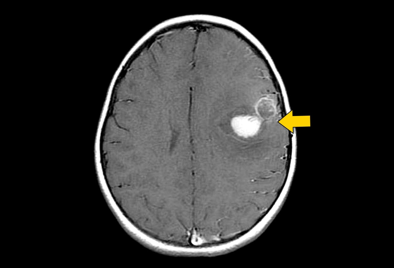 Pediatric Brain Tumors: Imaging Matters
